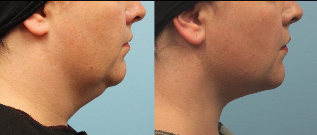 Body Contouring 101: Which Option Is Right for You? | Vancouver, BC ...