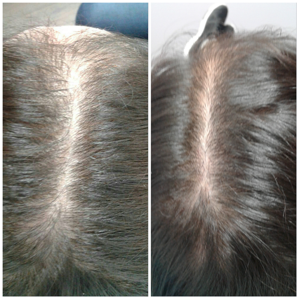 Can PCT Therapy Improve Skin & Hair? | YES Medspa & Cosmetic Surgery Centre